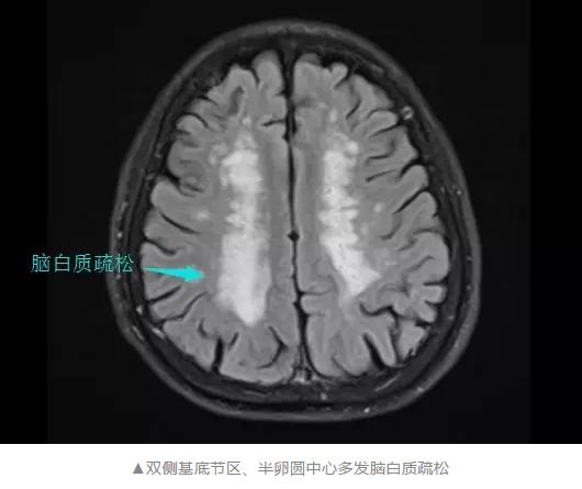 脑白质疏松症1级是什么意思