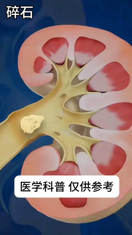 碎石对人体有害吗