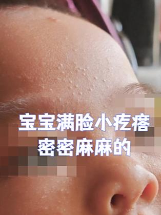热疹是什么原因造成的图标
