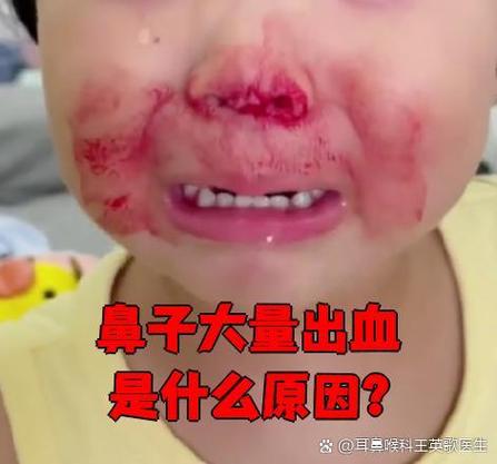 小孩流鼻血图标