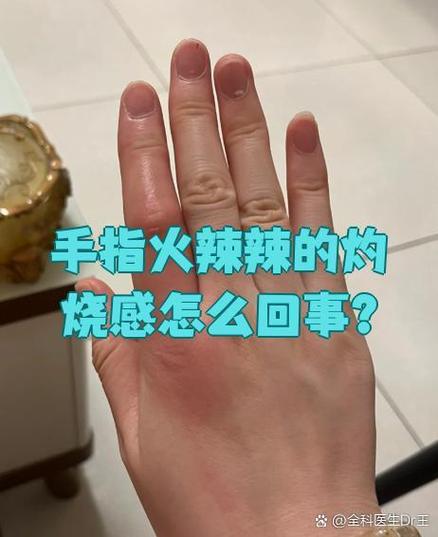 手指无缘无故火辣辣的灼烧感截图