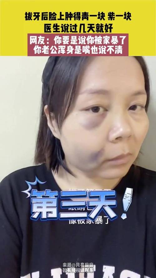 脸部手术淤青最多几天消除图标