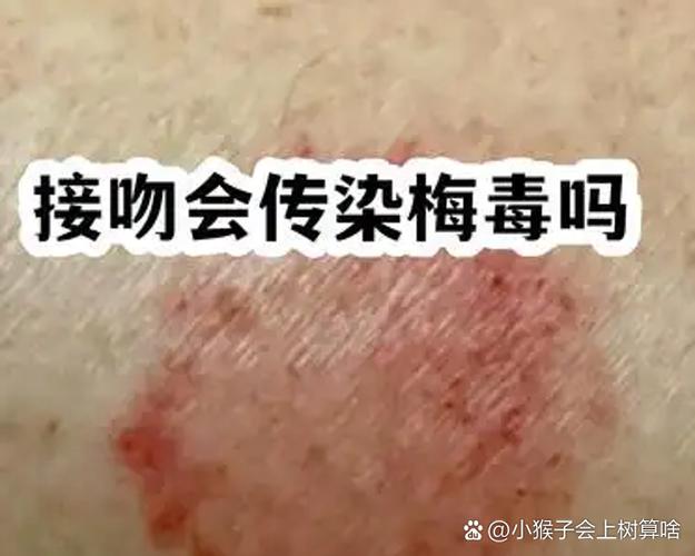 男生接吻伸舌头会不会传染疾病图标