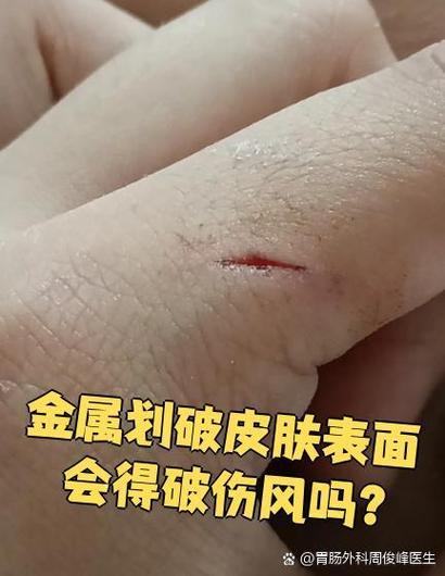 干净的金属有破伤风吗图标