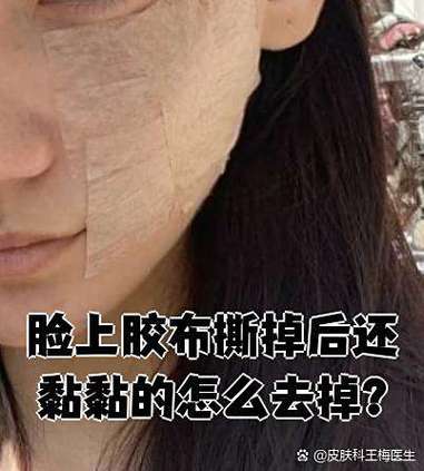 胶布撕掉后还黏黏的怎么去掉图标