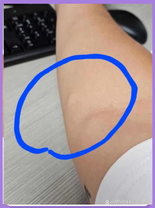 手臂上凸起一个肉包截图