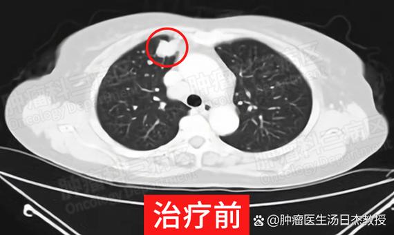 80岁老人肺部肿瘤怎么治疗截图