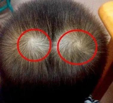 前额有发旋的人聪明吗截图