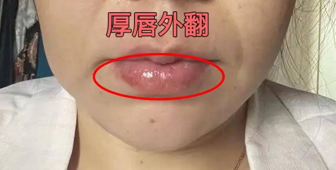 花唇红肿胀外翻图标
