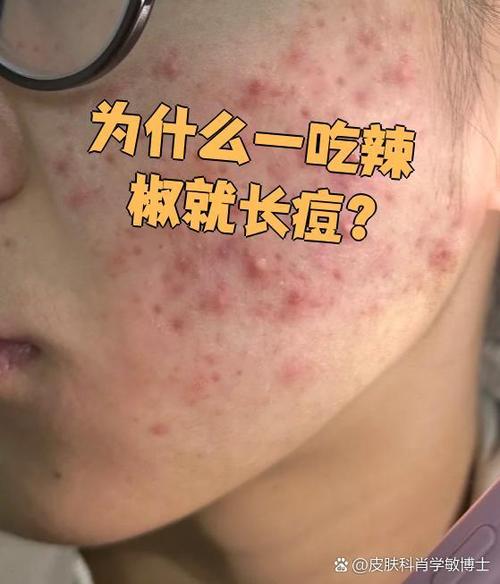 为啥吃辣痘痘就消了截图