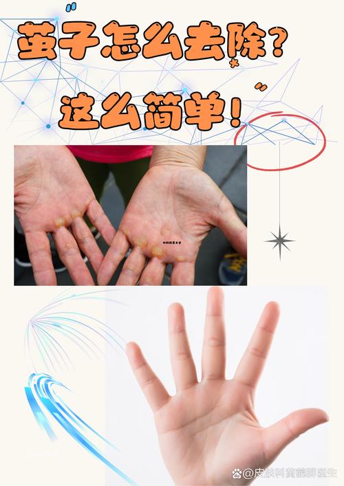 手上茧子怎样快速去掉图标