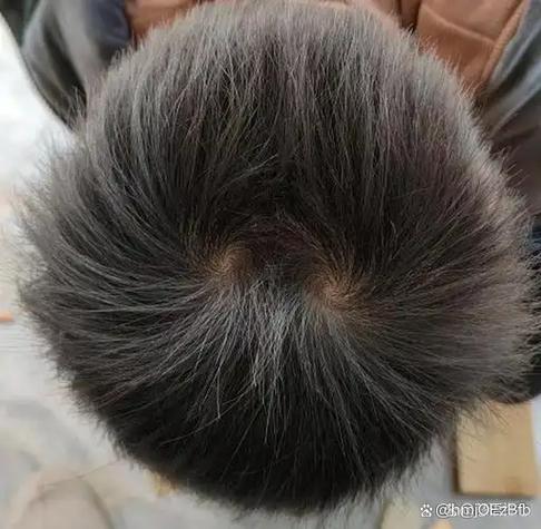 头顶旋处头发稀少是什么原因图标