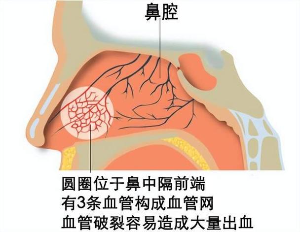 流鼻血堵住了什么时候取出来图标