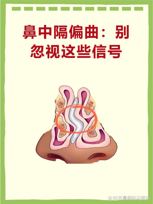 什么是鼻中隔病变截图