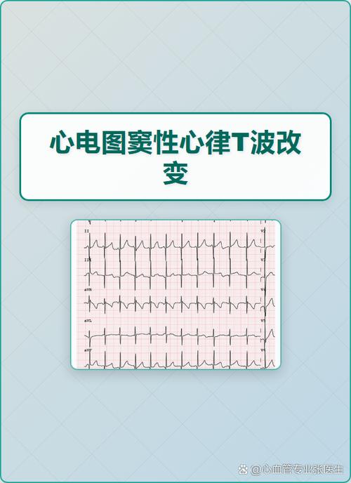 t波低平的临床意义图标
