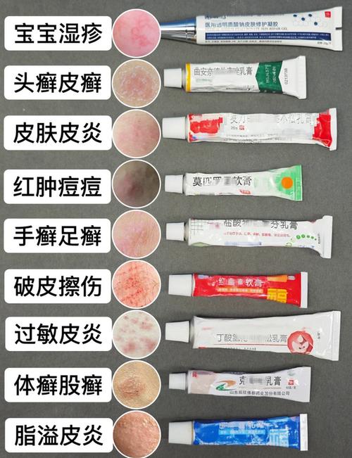 湿疹什么药最有效果截图