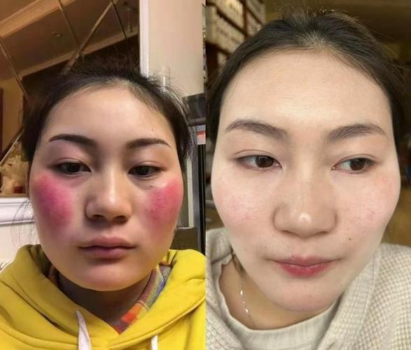 去除红血丝最有效的方法图标