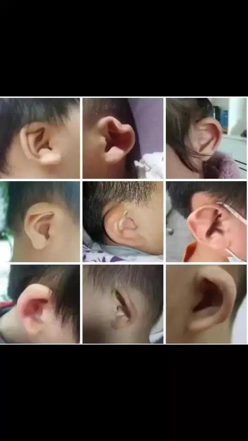婴儿耳朵为什么会畸形图标