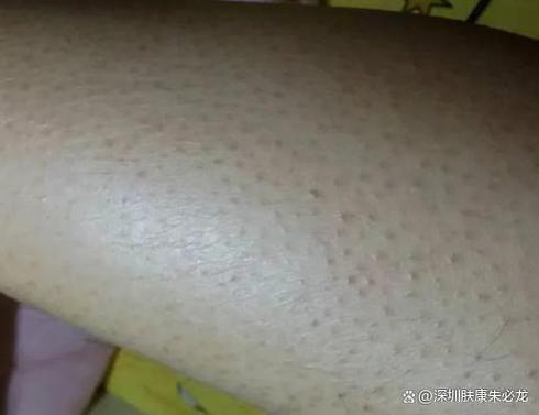 毛周角化能恢复到正常皮肤吗图标
