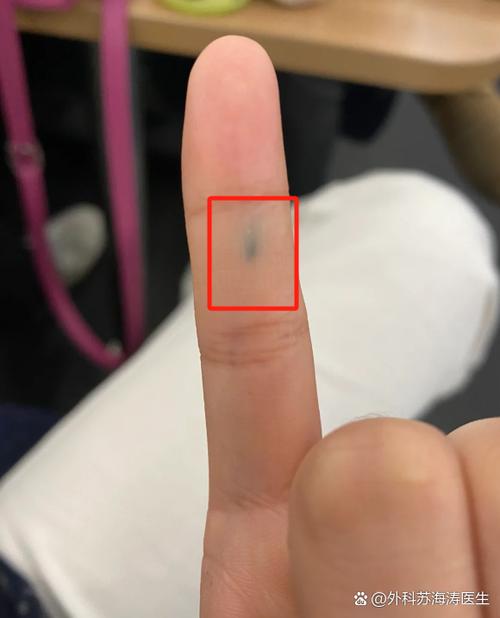 铅笔扎进肉里黑印处理