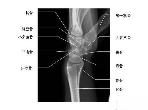 手的正位片和侧位片截图