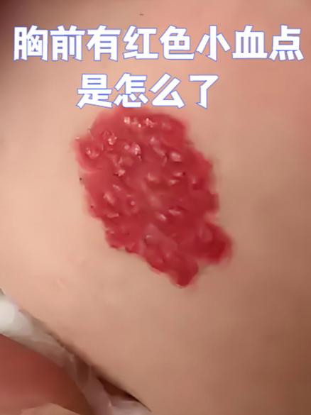 身上红色的小点越来越多怎么办