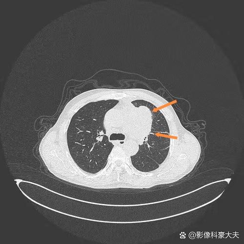 肺癌早期声音嘶哑特点图标