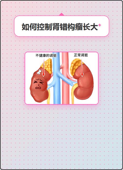肾良性肿瘤的三大特征图标