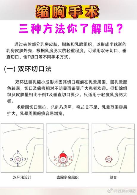 缩胸手术风险大吗图标