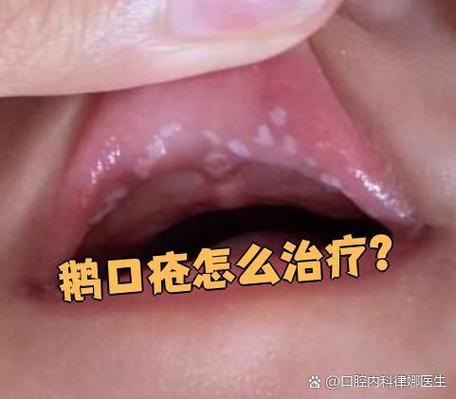 鹅口疮的治疗方法截图