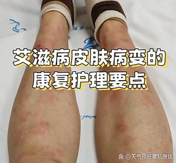 艾滋病的并发症有哪些图标