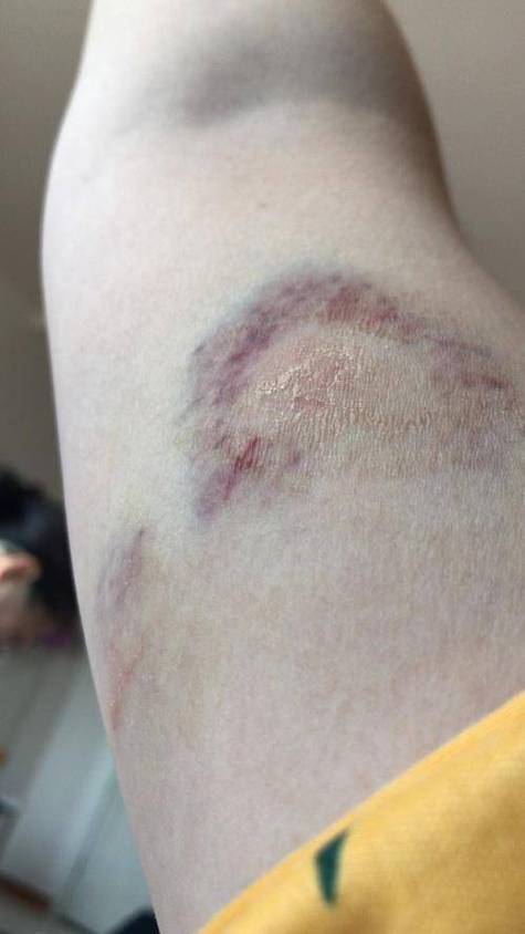 淤青对人体的危害图标
