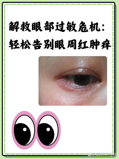 眼睛一圈红肿,痒,发红怎么办图标