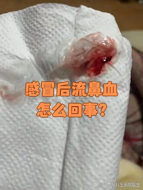 老是流鼻血严重吗