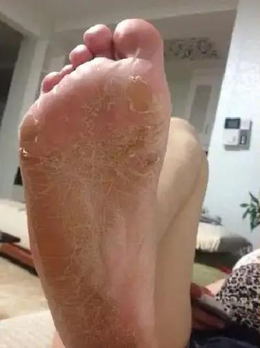 脚趾头痒怎么办图标