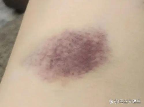 皮肤出现紫红色斑块图标