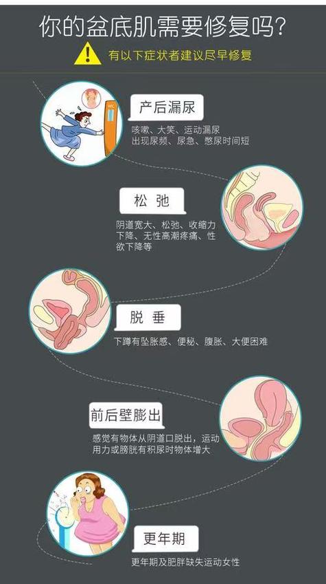 盆底肌修复是什么意思图标
