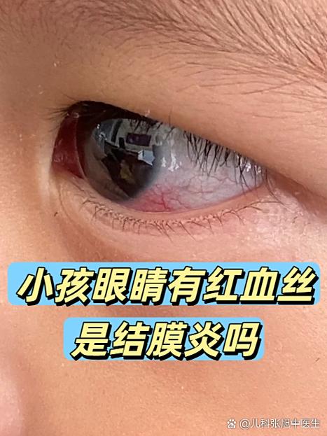 流鼻血眼睛红什么原因图标