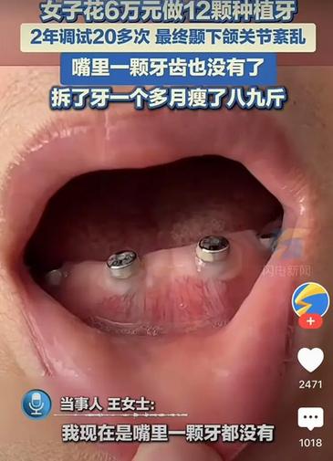 老牙掉了一颗怎么办截图