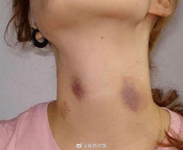 脖子上有淤青图片图标