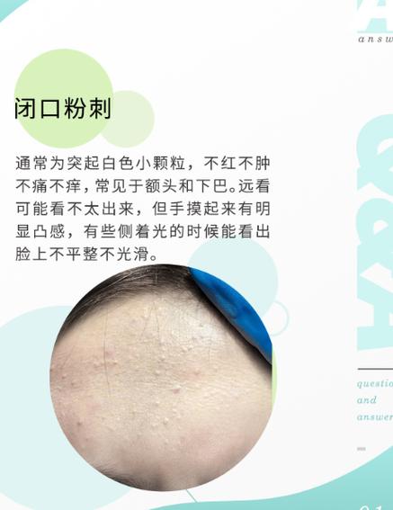 女孩额头上长痘痘怎么办图标