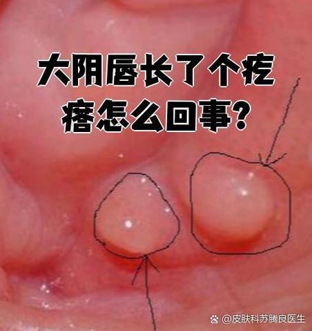 女性下面长出来一个疙瘩是怎么回事截图