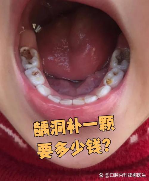 牙烂个洞补一补多少钱图标