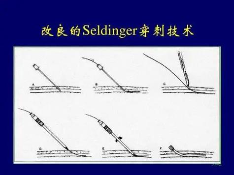 seldinger技术是什么图标