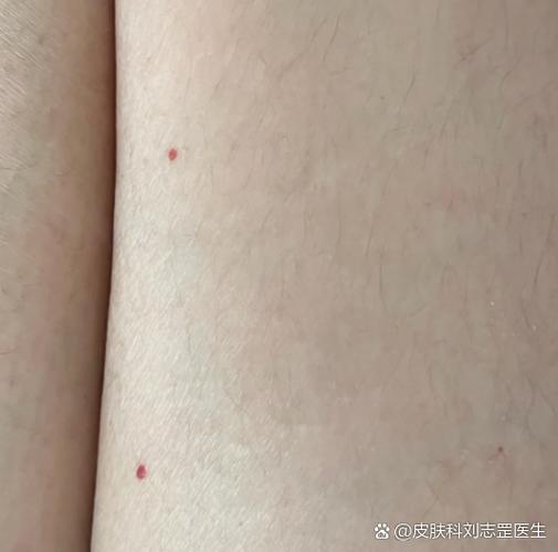 小红点像血点不痛不痒图标