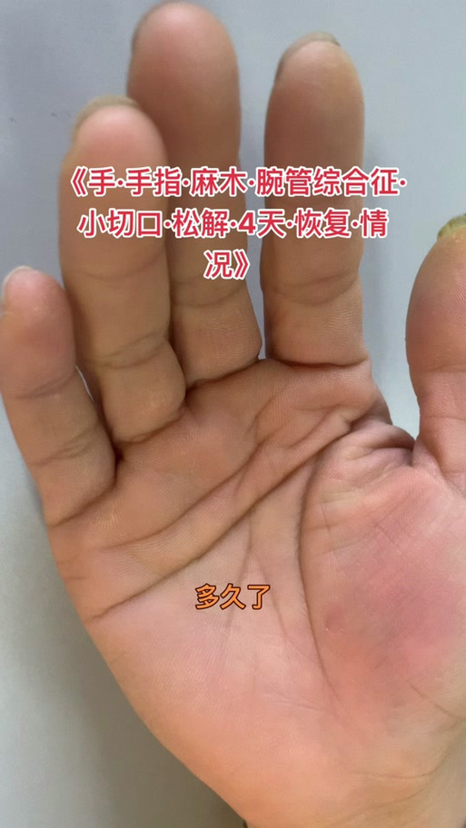 治疗手气的最佳方法图标