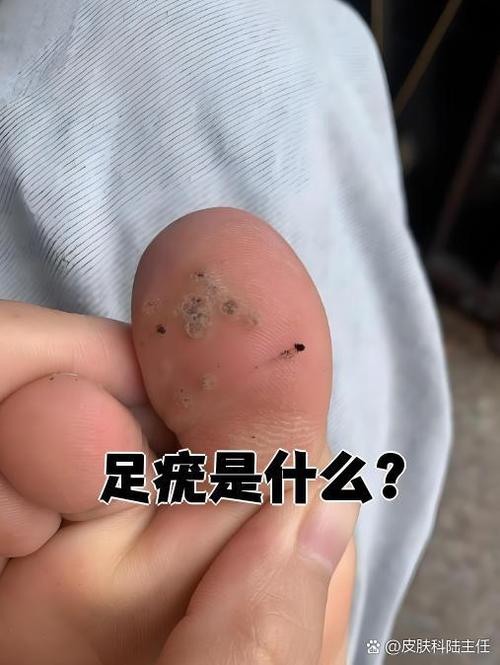 跖疣一般长在什么位置游戏截图
