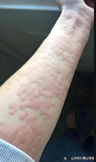 荨麻疹的照片图标