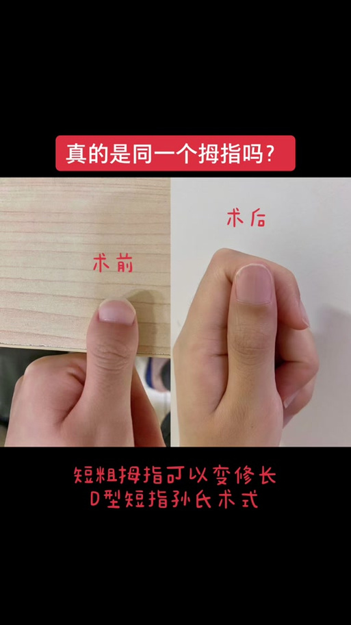手指短指畸形矫正图片图标