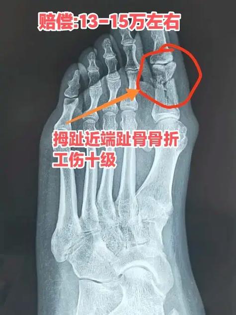 脚趾骨折能评上十级伤残吗图标
